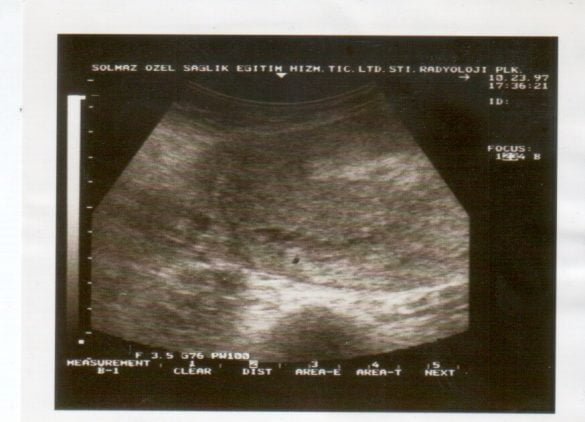 Embarazo ectópico: síntomas y riesgos para las mujeres